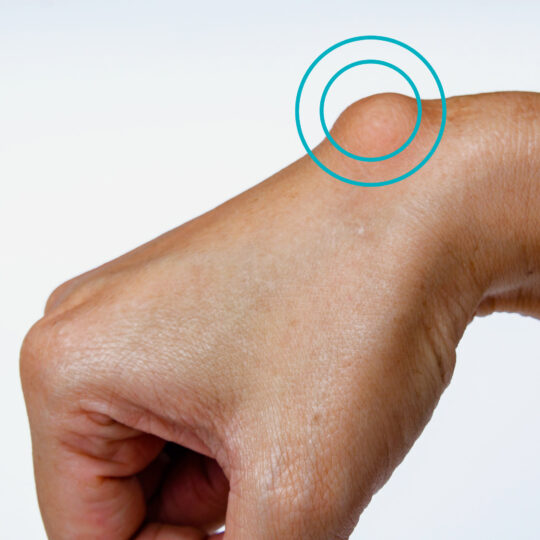 Kyste synovial – Dr Alexandru Datco